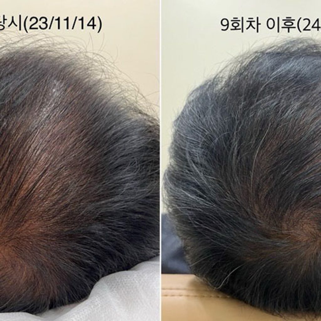 Hair Treatment Bellevue | Hair Regrowth Bellevue | Browever