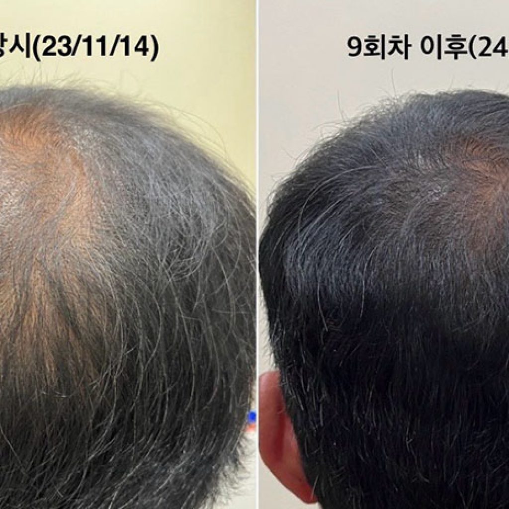 Hair Treatment Bellevue | Hair Regrowth Bellevue | Browever